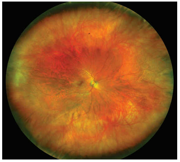 Optos Daytona Retinal Camera l Innovative Eye Care